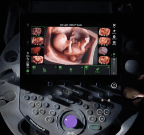 Revolutionising Prenatal Diagnosis with GE Voluson Expert 22 Ultrasound